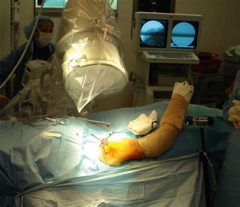 Technique Spotlight Orif Proximal Humerus Fracture With Imn Clinical