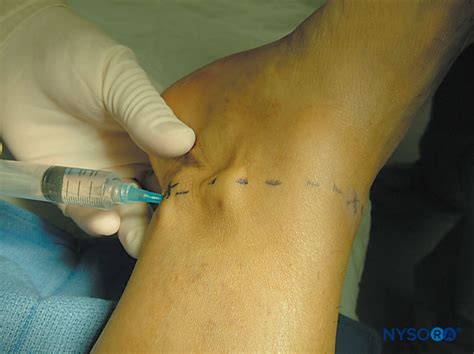 Ankle Block Landmarks And Nerve Stimulator Technique NYSORA