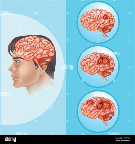 Brain Tumor Diagram