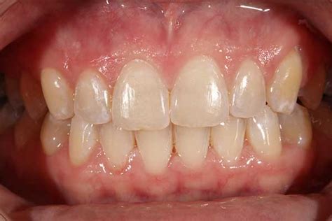 Clear Correct Aligners Patient Before And Afters McOmie Dentistry Chattanooga