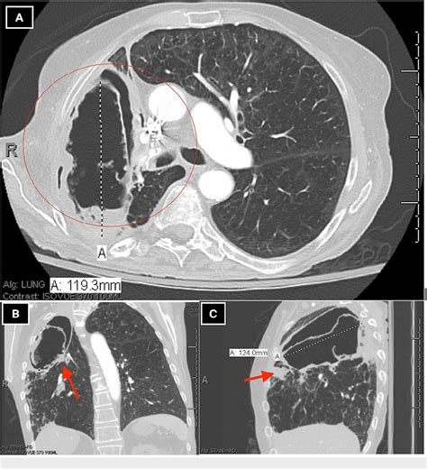 Pdf A Case Of Invasive Pulmonary Aspergillosis Vs Pulmonary