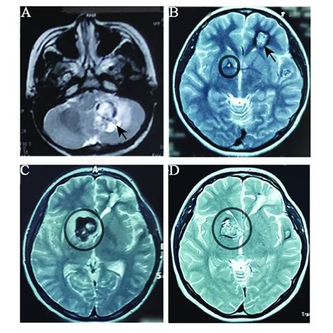 Xiaoying Cui Md Phd The University Of Queensland Brisbane Uq Queensland Brain Institute