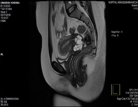Multiple Nabothian Cysts Download Scientific Diagram