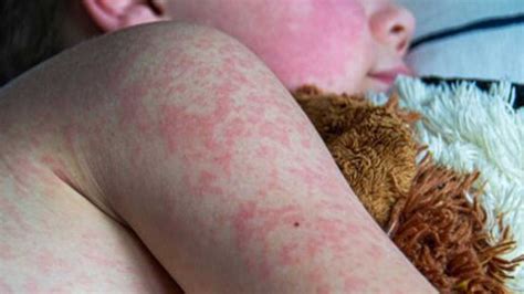 بیماری پنجم چیست؟ روش های درمان بیماری پنجم مهتاج گالری