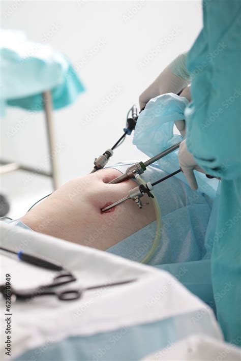 The Doctor Performs The Operation Using A Camera And A Tool Laparoscopic Surgery Penetration