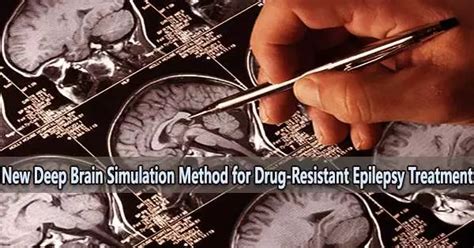 New Deep Brain Simulation Method For Drug Resistant Epilepsy Treatment