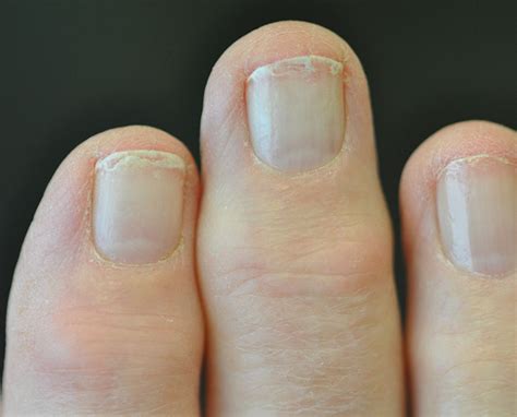Fungal Nail Infection Diagnosis And Management The Bmj