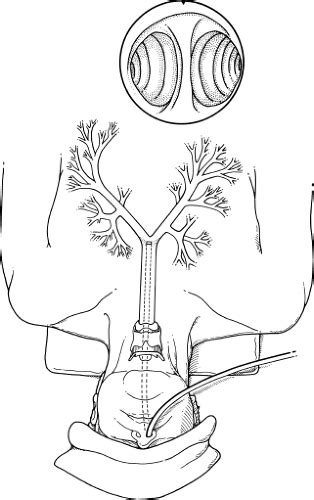 Bronchoscopy Basicmedical Key