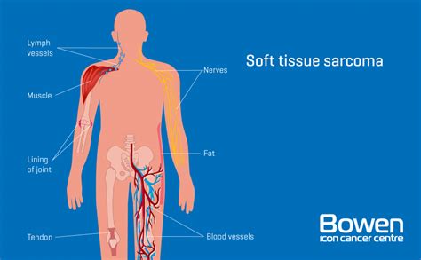 What Is Soft Tissue Sarcoma Soft Tissue Sarcoma Explained — Bowen Icon Cancer Centre