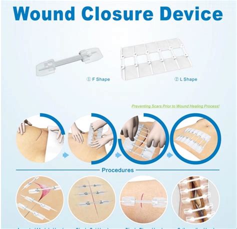 Wound Closure Device Lina Medical