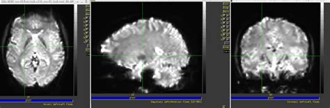 Problems With CSF During FMRI Distortion Correction Portion Of FMRIprep