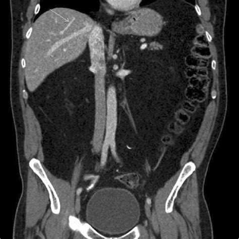 Ct Scans Showing Portal Vein Embolization And Left And Middle Hepatic Download Scientific