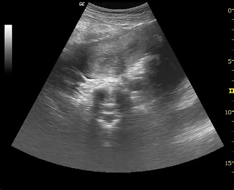 Transverse Ultrasound Image Showing Two Uterine Cavities With Echogenic
