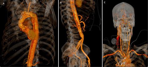 Three Dimensional Computed Tomography Angiographic Reconstruction Download Scientific Diagram