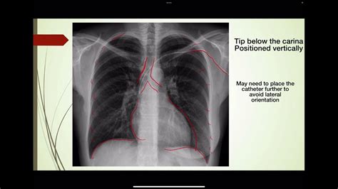 Cxr Basics Line Placement And Ett Verification Youtube