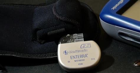 When Medications Dont Help Gastroparesis Some Find Relief In Implanted Device Cbs Pittsburgh