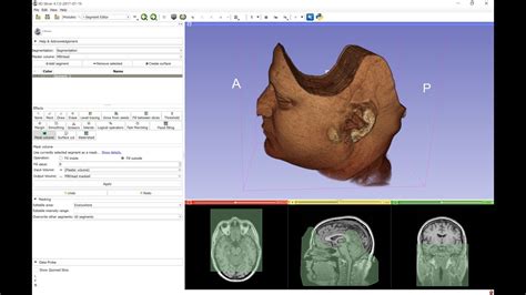 New Surface Cut And Mask Volume Tools For 3d Slicer Segment Editor Youtube