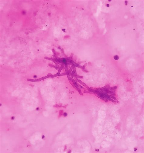 Septate Acute Angle Branching Fungal Hyphae Consistent With Aspergillus