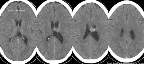 Dr Balaji Anvekar Frcr Intraventricular Cavernoma
