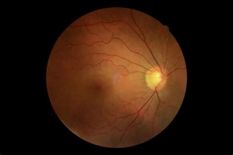 Nerf Optique Et Glaucome Impact Sur La Vision Et Les Traitements