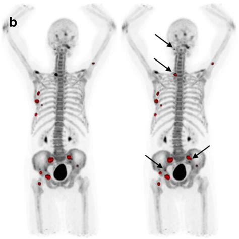 Schematic Of The Ai Model The Lesion Cnn Segments Suspected Metastatic Download Scientific