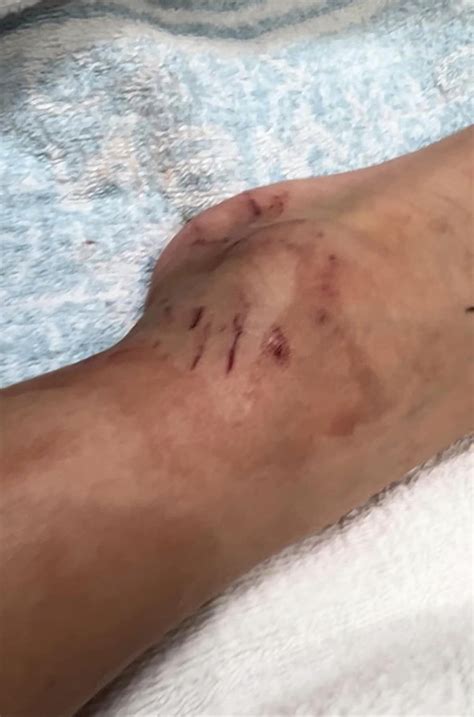 Python Bites And Drags 5 Year Old Australian Boy Into Pool