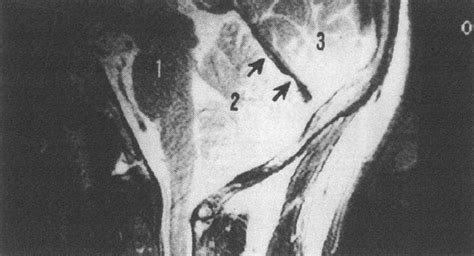小脑正中矢状切面mri图 T2w Ct解剖图谱
