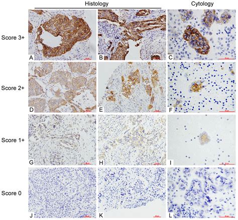 Staining Of Egfr Mutation Specific Antibodies Representative Download Scientific Diagram