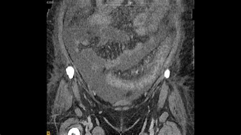 Pseudomembranous Colitis Confirmed Case Ct Findings Youtube
