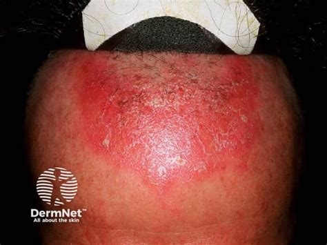 Contact Dermatitis Image