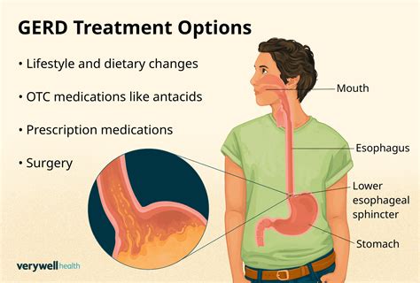 Gerd Symptoms 3 Gerd Symptoms That Are Ruining Your Life — Atlantic