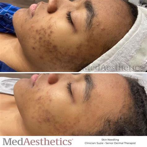 Dermapen Skin Needling Perth Stolen Moment Beauty Check Out These
