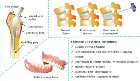 Pmma 骨水泥的机械和生物活性特性：综述 Acs Biomaterials Science And Engineering X Mol