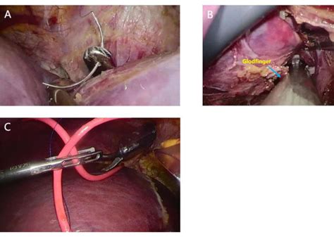 Video Laparoscopic Anterior Right Hepatectomy A Single Center Experience