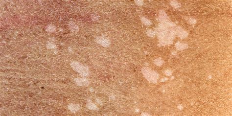 White Patch On Skin A Cause For Concern Self