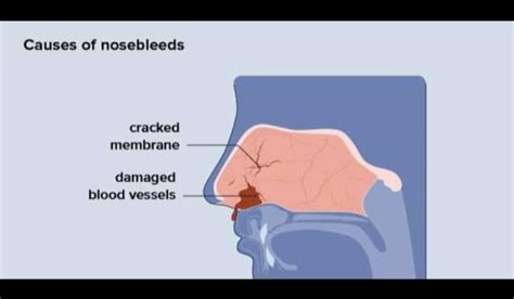Bandj Ent Specialist Available For Nasal Cautery Or Nasal