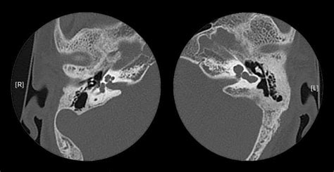 Incomplete Cochlear Partition Type I Dr Sanu P Moideen