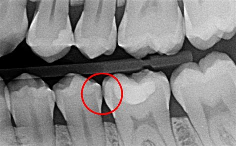 Interproximal Initial Caries In A Patient With High Caries Experience