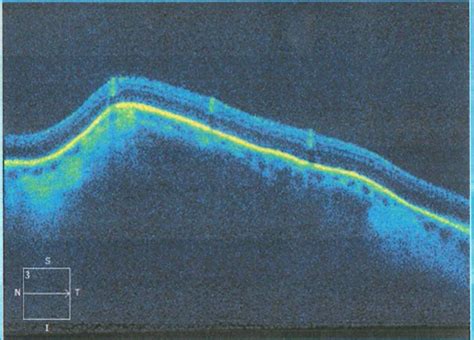 Sclerochoroidal Calcification Leads To Diagnosis Of Primary Parathyroid Cancer Published In