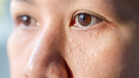 Milia Seeds Removal Safe Treatment For Clear Skin