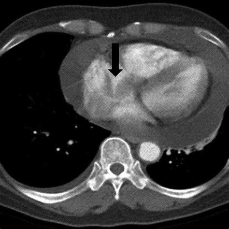 Two Dimensional Cardiac Echocardiogram In A Subcostal View Of The Download Scientific Diagram