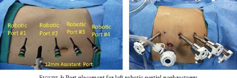 Figure 3 From Robotic Partial Nephrectomy With The Da Vinci Xi