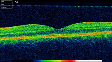 Optical Coherence Tomography Oct Billingham