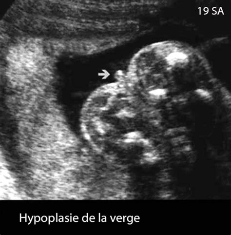 Hypoplasie Verge Dr Kara Zaitri Ma