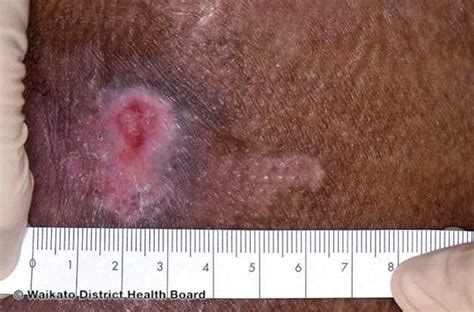 Pressure Ulcers — Skin For All