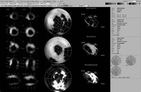 Radionuclide Myocardial Perfusion Scintigraphy Results Download Scientific Diagram
