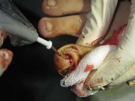 Vandenbos Photos Overgrown Toeskin