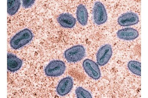 Gay And Bisexual Men Diagnosed With Mpox Face Substantial Stigma Finds