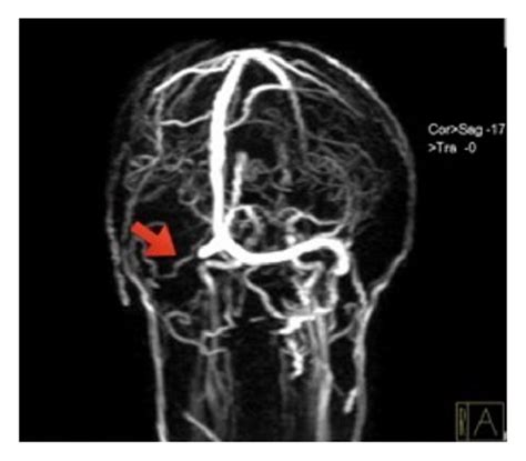 Mri Venography Showing Right Transverse And Sigmoid Sinus Thrombosis Download Scientific