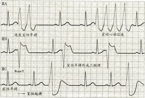 过早搏动 心血管 医学